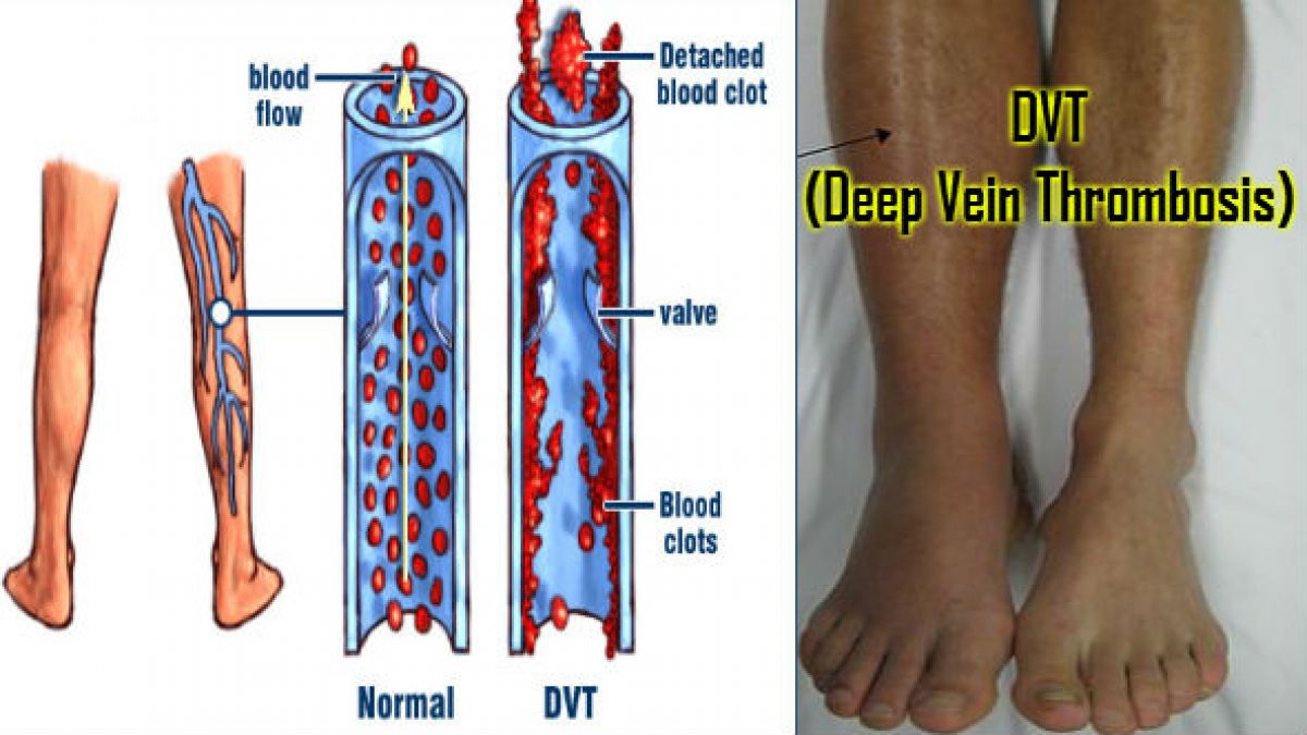 What Is Deep Vein Thrombosis Dvt Thrombosis Deep Vein - vrogue.co What Is Deep Vein Thrombosis Dvt Thrombosis Deep Vein - vrogue.co