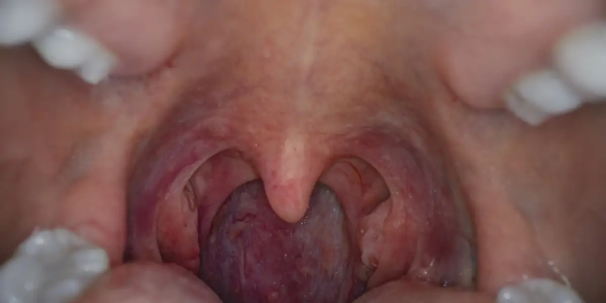 Tonsil Cancer Symptoms Causes And Treatment Medically Speaking