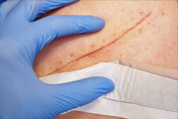 Mercury Poisoning: What Happens to Your Body If You Accidentally Ingest ...